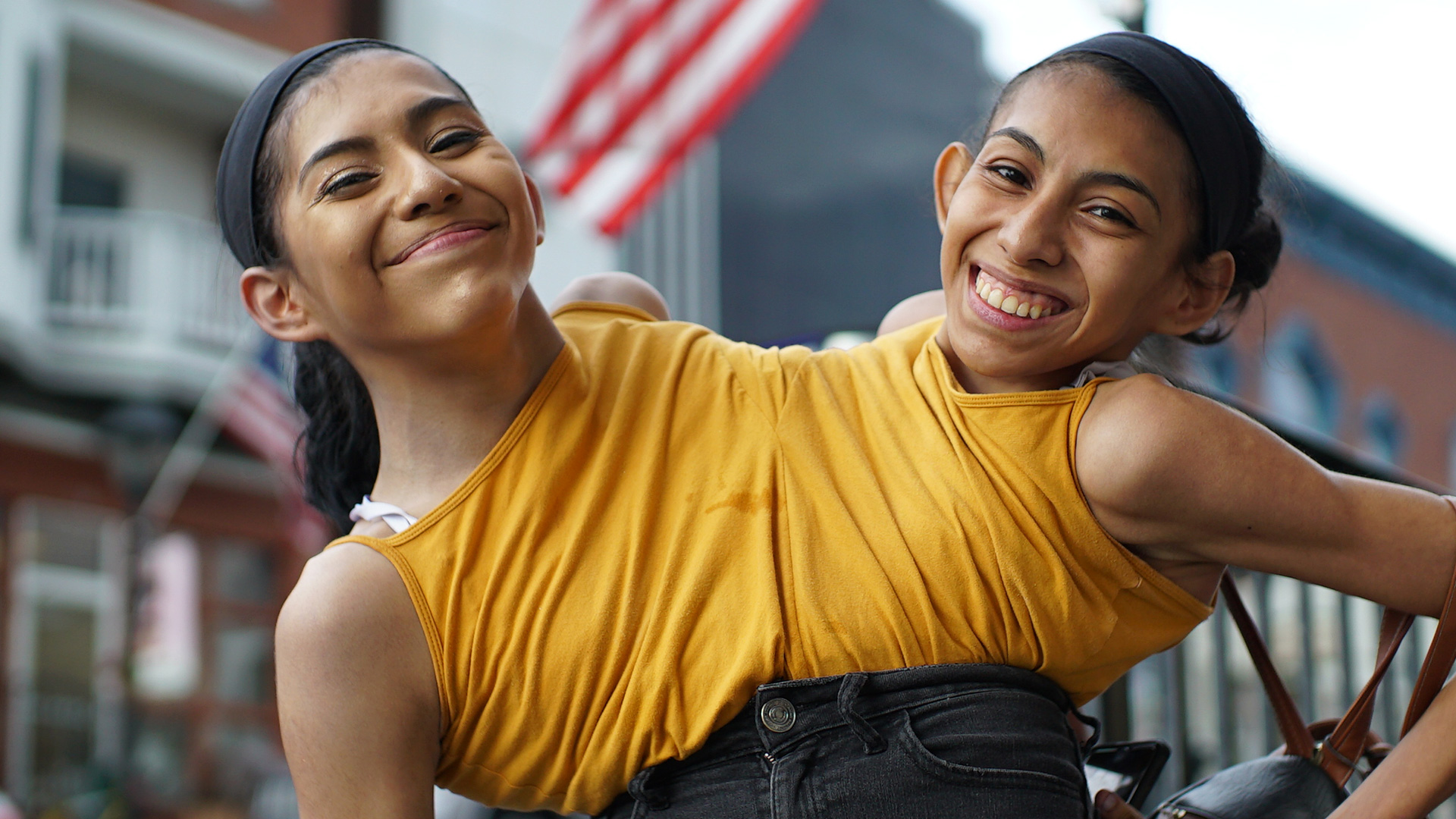 Famous Conjoined Twins Who Have Been Separated